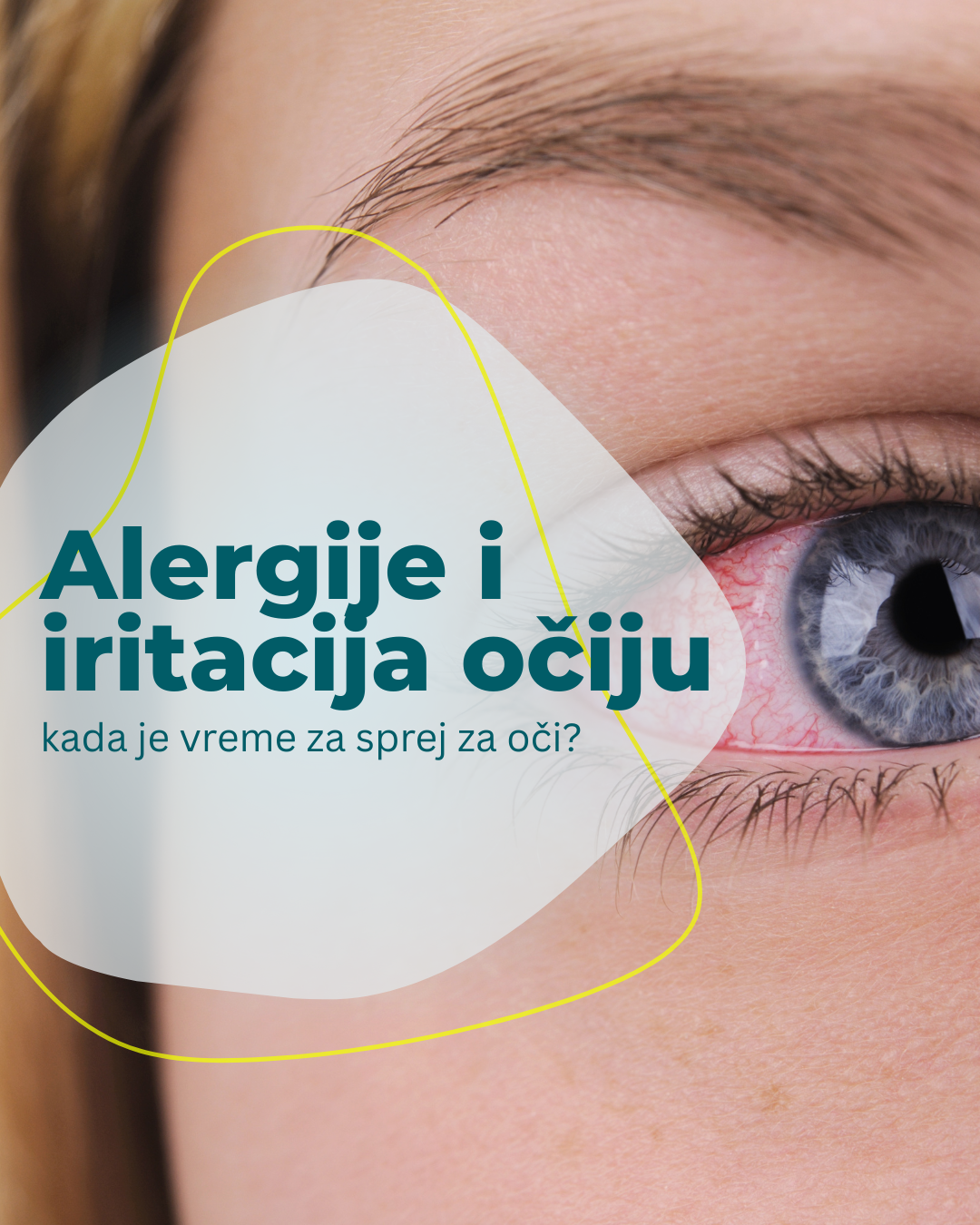 Alergije i iritacija očiju – kada je vreme za sprej za oči? - Lertal